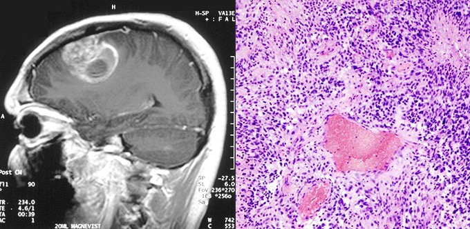 Groundbreaking Treatment For Aggressive Brain Cancer - The Canadian ...